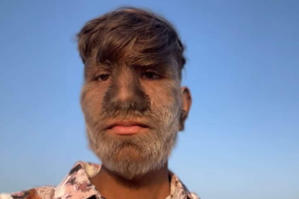 O Fenômeno da Hipertricose: A História de Lalit Patidar - TEX